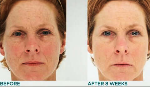 LightStim Medical-Grade LED Anti-Wrinkle Kit | Dr. Nazarian